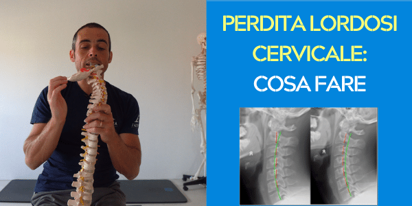 Scomparsa Della Fisiologica Lordosi Cervicale - balabaladora Scomparsa Della Fisiologica Lordosi Cervicale - balabaladora