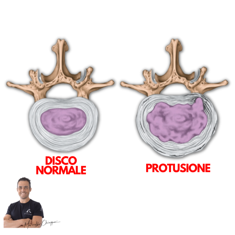 Sintomi cervicale: quali sono e come interpretarli