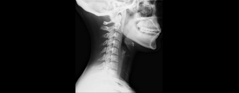 Cos'è l'artrosi cervicale (uncoartrosi o spondilouncoartrosi), che ...