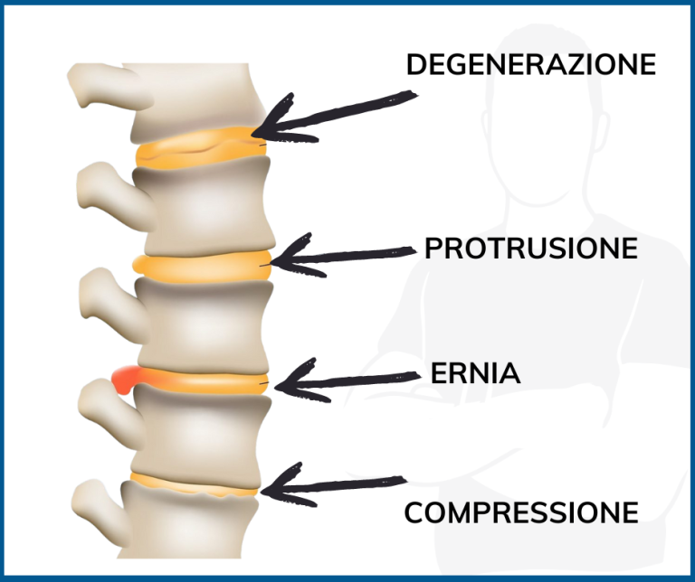 Discopatia o prutrusione C5-C6 o C6-C7: ecco cosa fare subito!