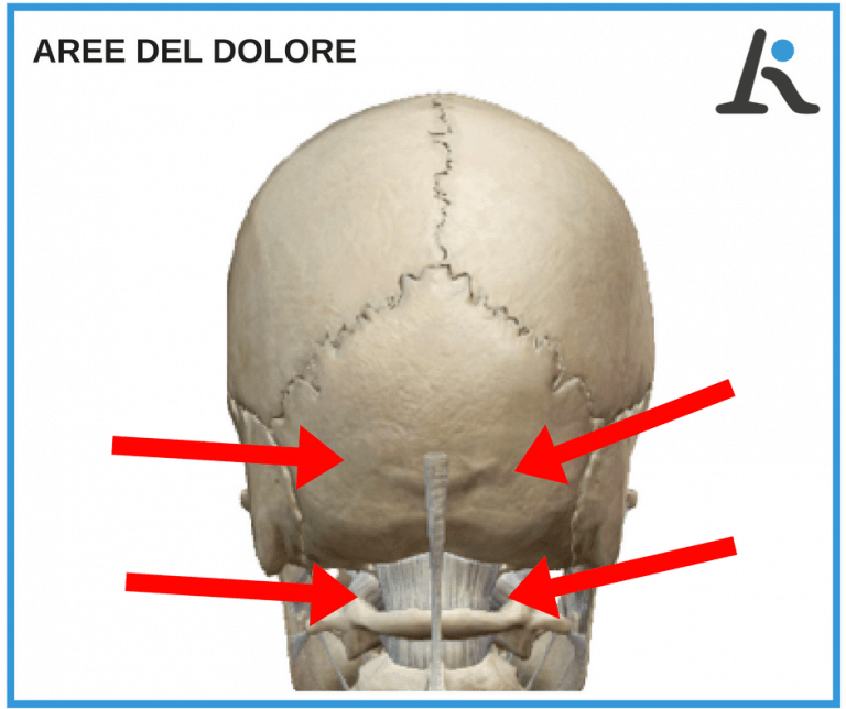 Dolore alla nuca: come risolvere un sintomo spesso legato alla ...
