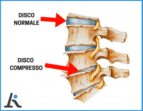 Spondiloartrosi, ernie del disco e discopatie: riscontri radiologici