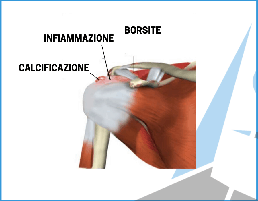 Dolore alla spalla: quando serve l'intervento chirurgico