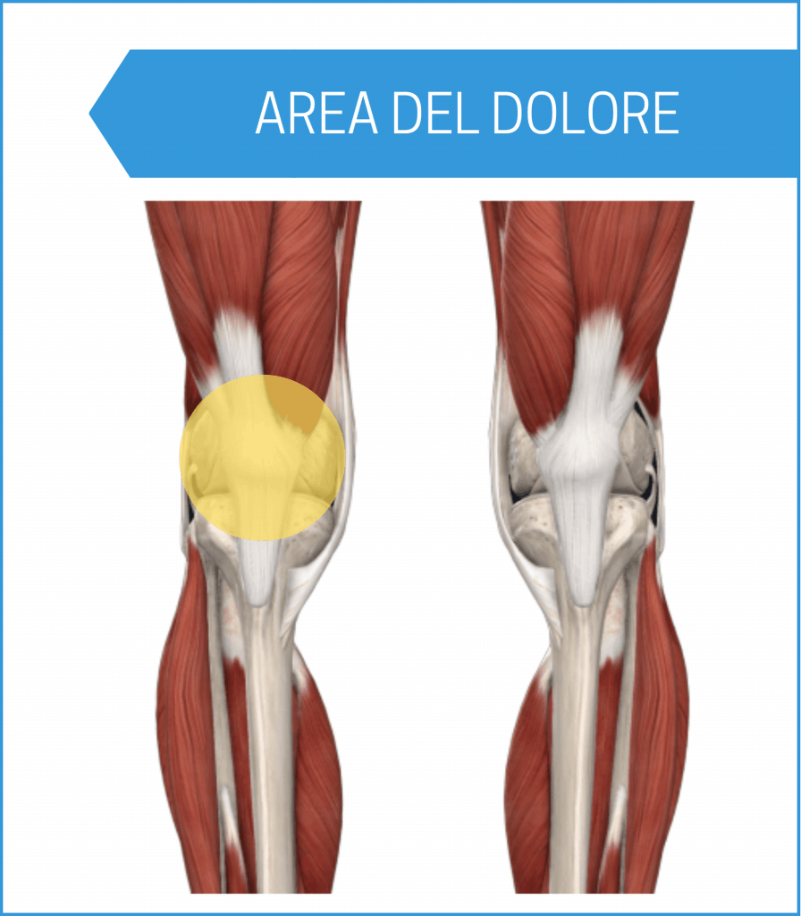 Sindrome femoro rotulea: che cos'è e cosa fare?