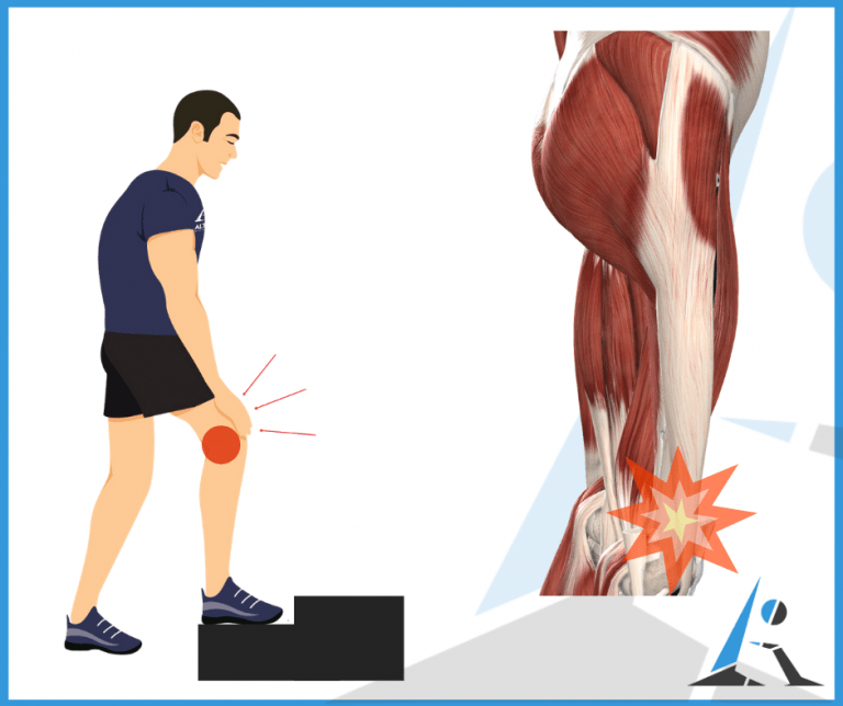 Sindrome della bandelletta ileotibiale: la guida completa