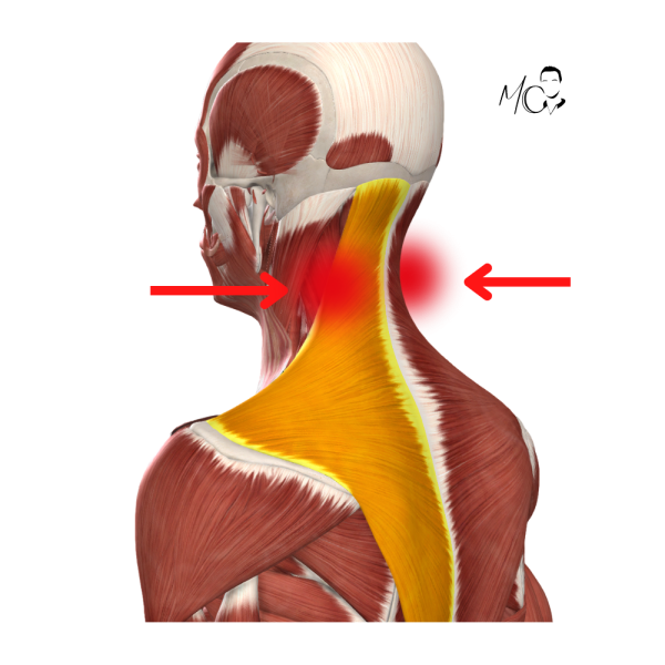 Dolore al collo lato destro o sinistro? La causa è il TRAPEZIO