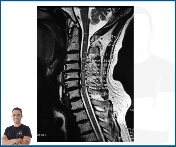 Risonanza magnetica cervicale: un esame inutile?