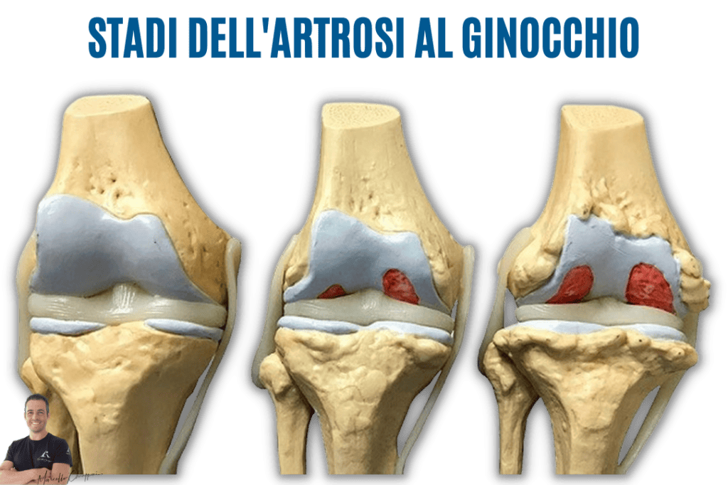 I migliori esercizi per l'artrosi al ginocchio (+ quelli da evitare)