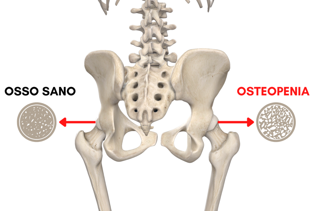 Osteopenia: una possibile causa di mal di schiena?