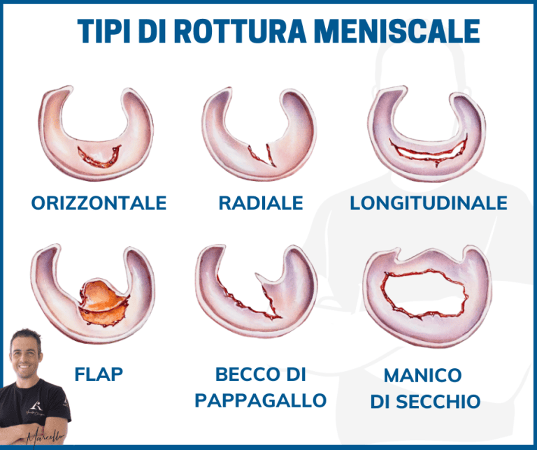 Guida al menisco rotto: tipi di rottura e sintomi