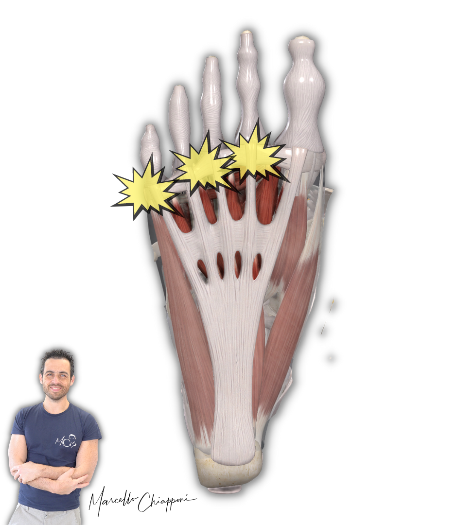 Dolore al piede: punti critici, cause e rimedi "muscolari"