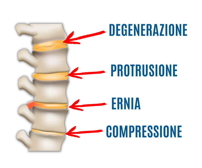 Come risolvere i problemi di DISCOPATIE CERVICALI (guida completa) - L ...